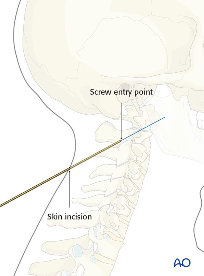 Transarticular screw insertion
