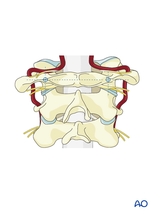 C1 lateral mass screw insertion
