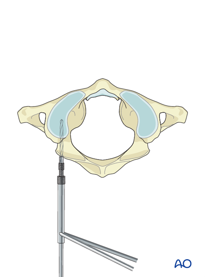 C1 lateral mass screw insertion