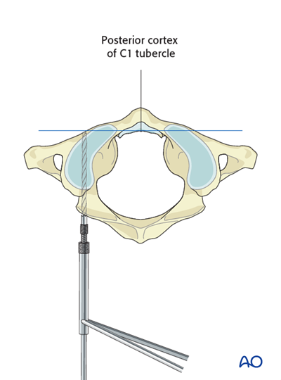 C1 lateral mass screw insertion