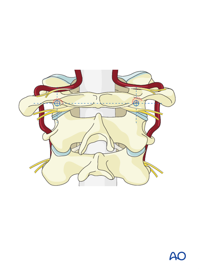 C1 lateral mass screw insertion