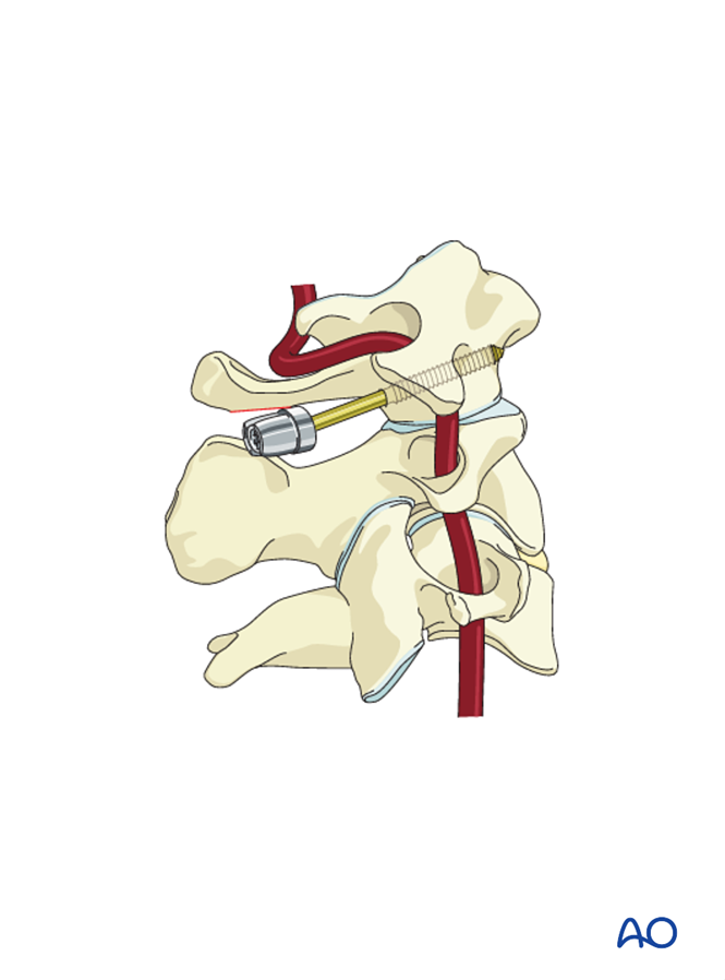 Posterior C1–C2 fusion for Region II Type C: Translation injury of the ...