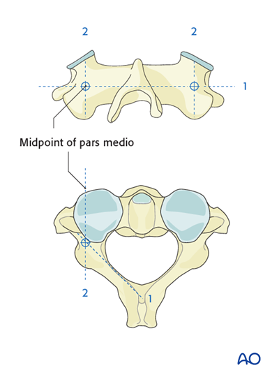 C2 pedicle screw insertion