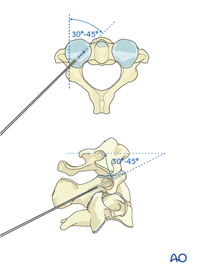 C2 pedicle screw insertion