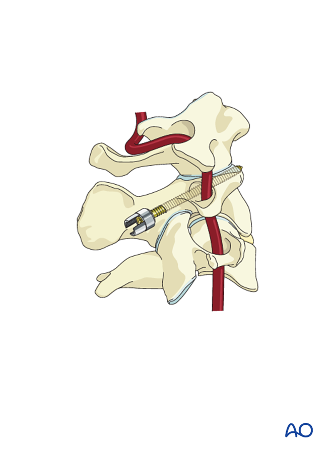 C2 pedicle screw insertion