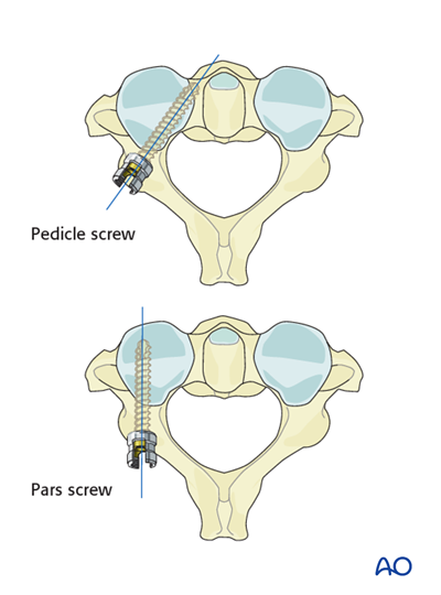C2 pedicle screw insertion