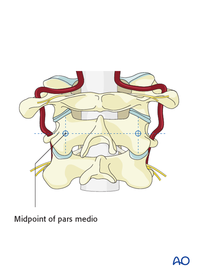 C2 pars screw insertion