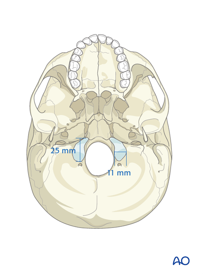 Occipital condyle screw insertion