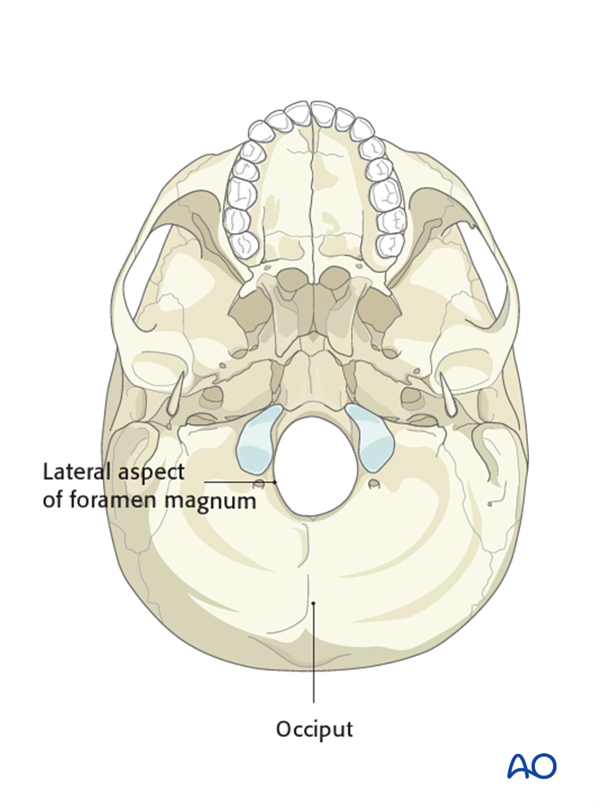 Occipital condyle screw insertion