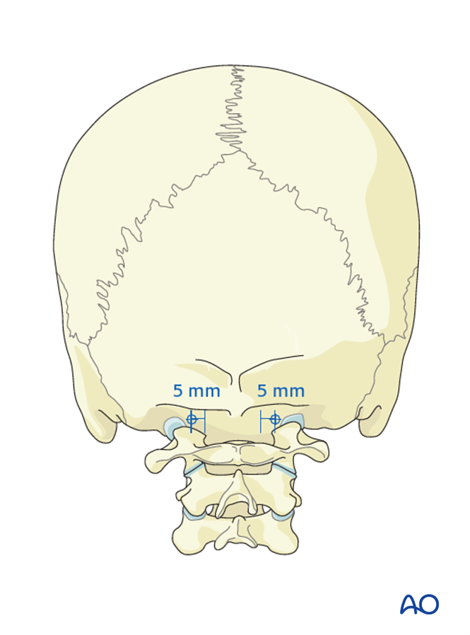 Occipital condyle screw insertion