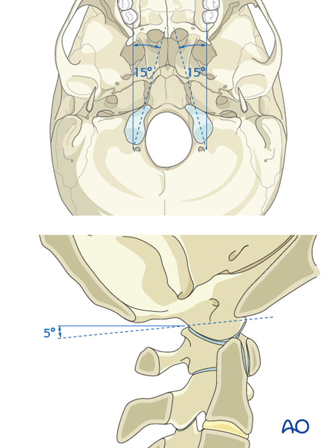 Occipital condyle screw insertion