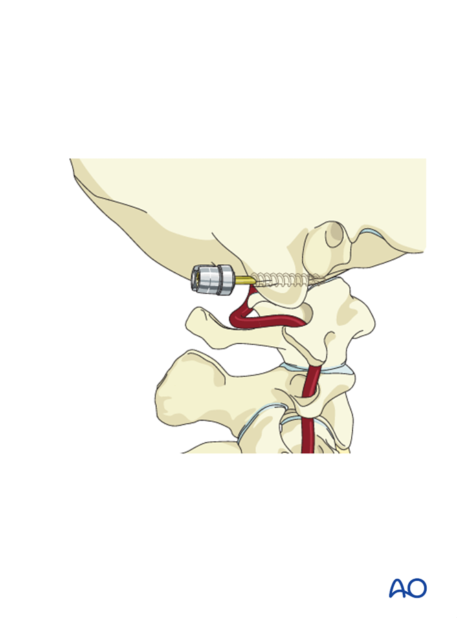 Occipitocervical fusion IB and IC for Region I Type C: Any injury with ...