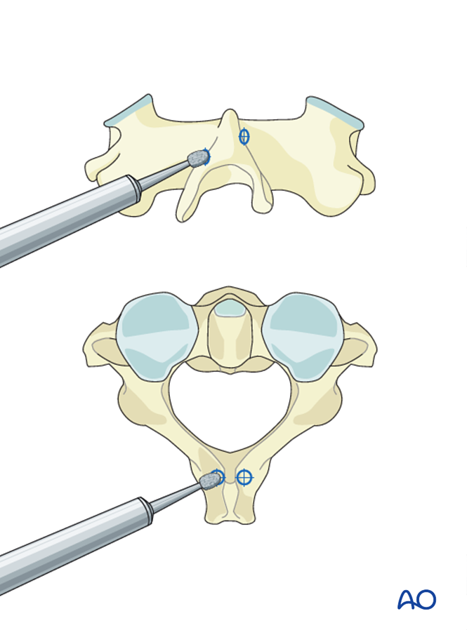 C2 laminar screw insertion