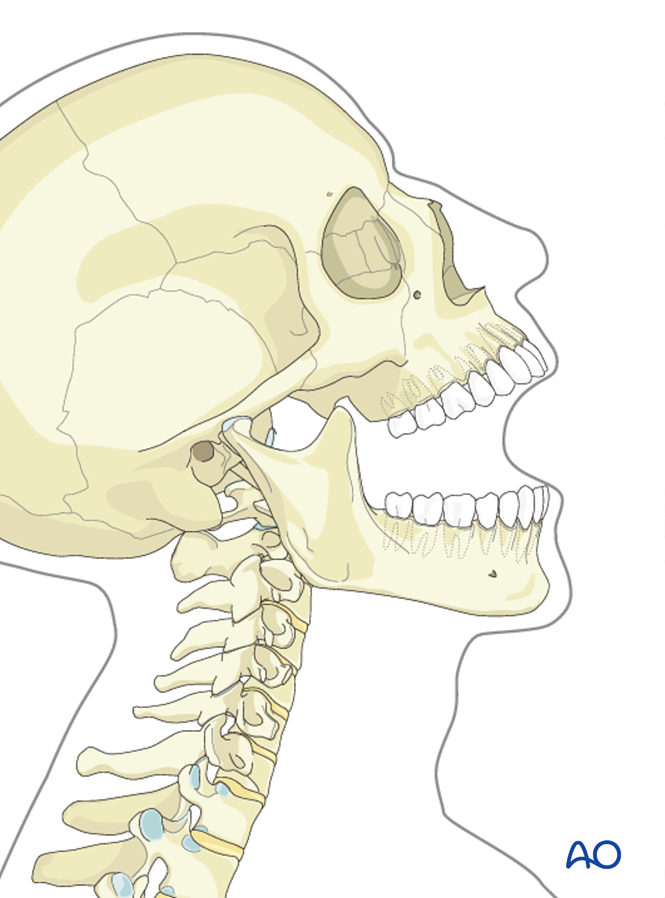 Anterior C1–C2 transarticular screw insertion