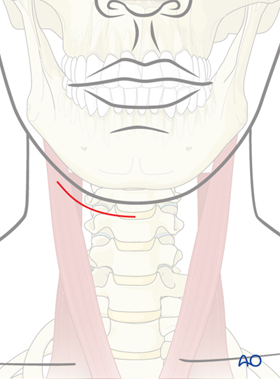 Anterior C1–C2 transarticular screw insertion