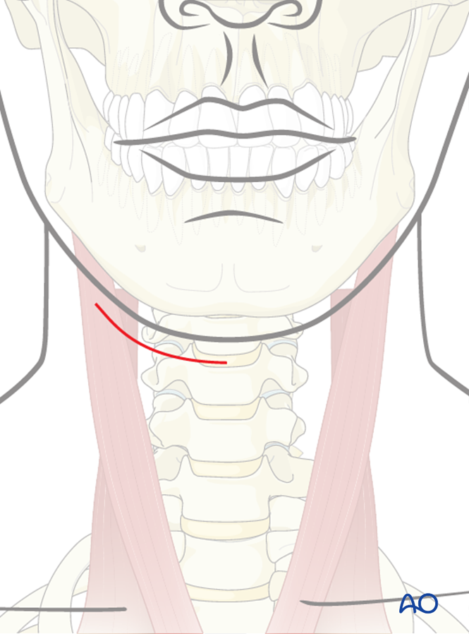 Anterior C1–C2 transarticular screw insertion