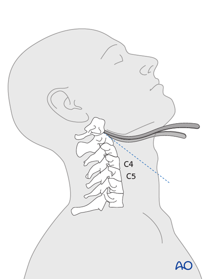 Anterior C1–C2 transarticular screw insertion