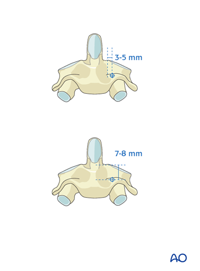 Anterior C1–C2 transarticular screw insertion