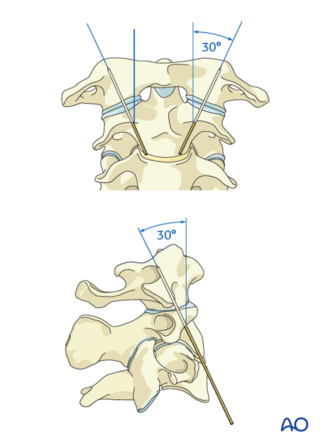 Anterior C1–C2 transarticular screw insertion