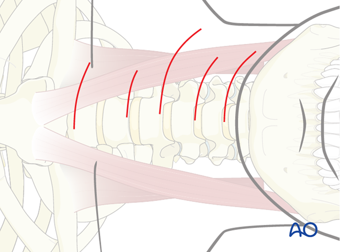 Anterior approach to the cervical spine