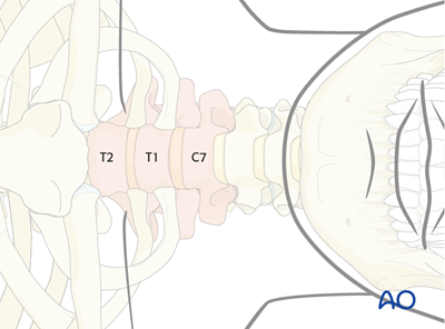 Anterior approach to the cervico thoracic junction