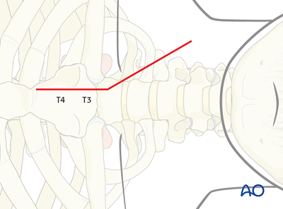 Anterior approach to the cervico thoracic junction