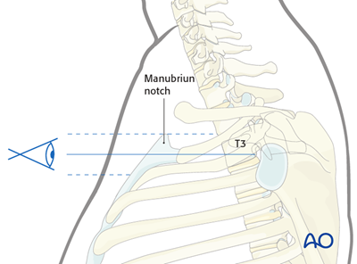 Anterior approach to the cervico thoracic junction