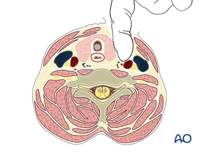 Anterior approach to the cervico thoracic junction