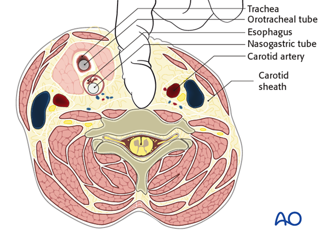 Anterior approach to the cervico thoracic junction