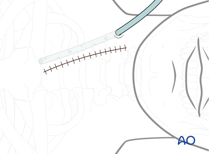 Anterior approach to the cervical spine