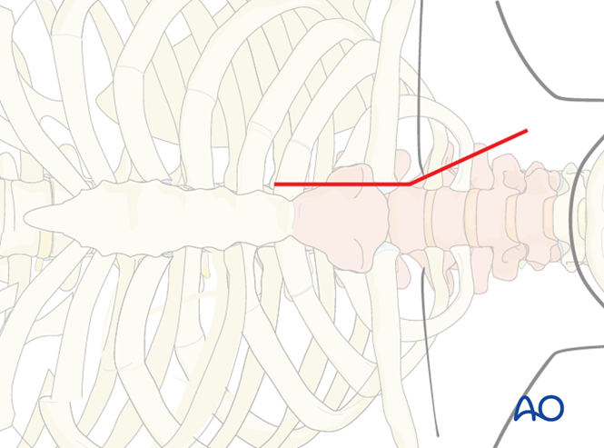 Anterior approach to the cervico thoracic junction