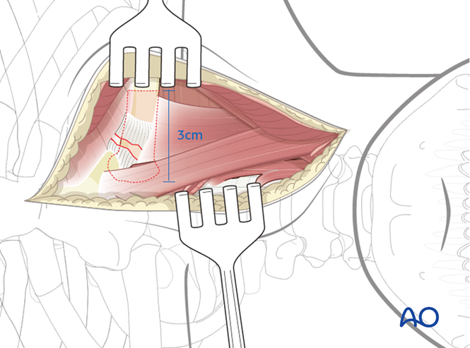 Anterior approach to the cervico thoracic junction