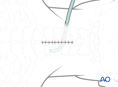 Posterior approach to the cervical spine