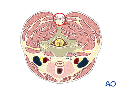 Posterior access to the thoraco cervical junction