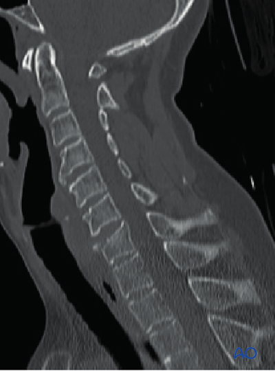 A1 Compression fracture single endplate