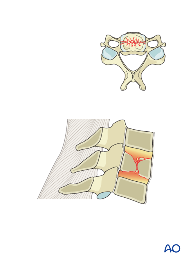 A2 Coronal split/pincer fracture