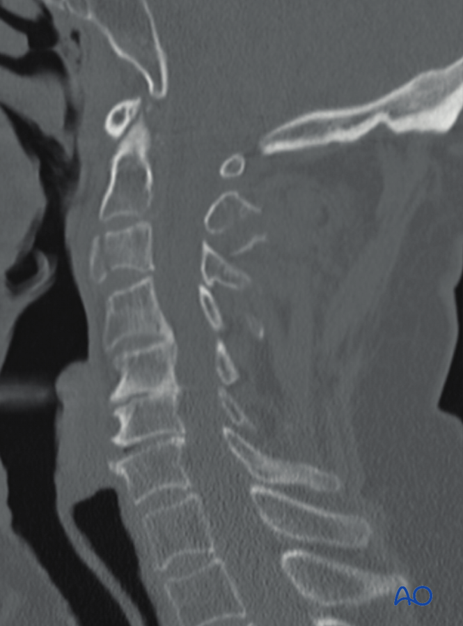 A2 Coronal split/pincer fracture