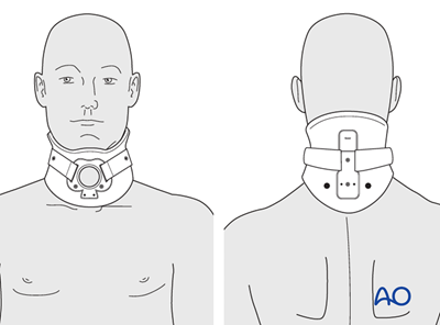Nonoperative (collars) for A0 - Minor, nonstructural fractures
