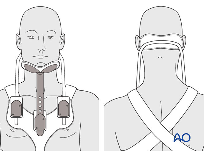 Nonoperative (collars) for A1 Compression fracture single endplate