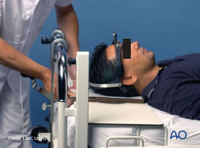 Nonoperative (halo vest) for A3 Burst fracture of single endplate