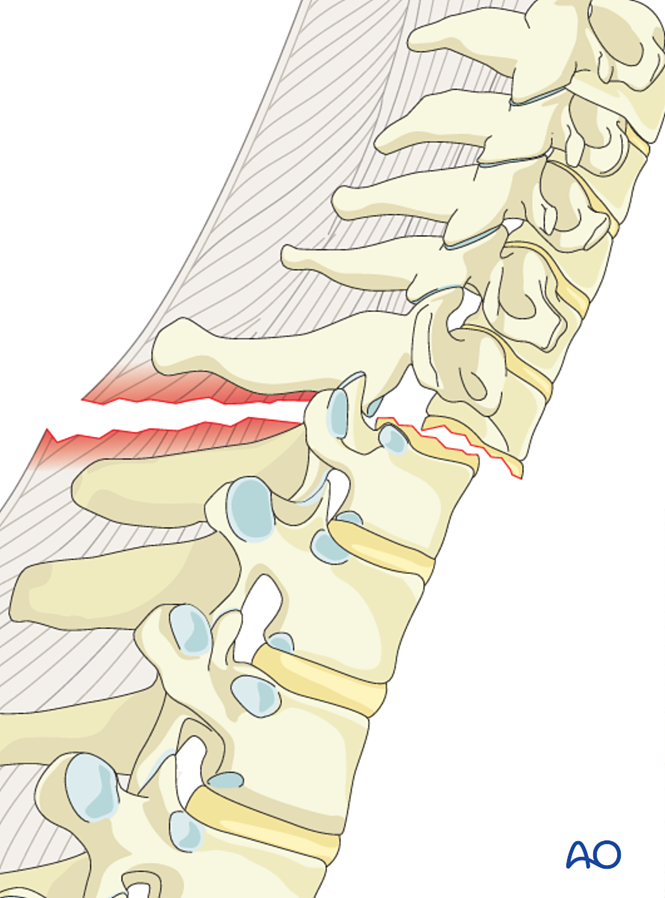 Cervicothoracic junction - posterior fixation for C Translational injury
