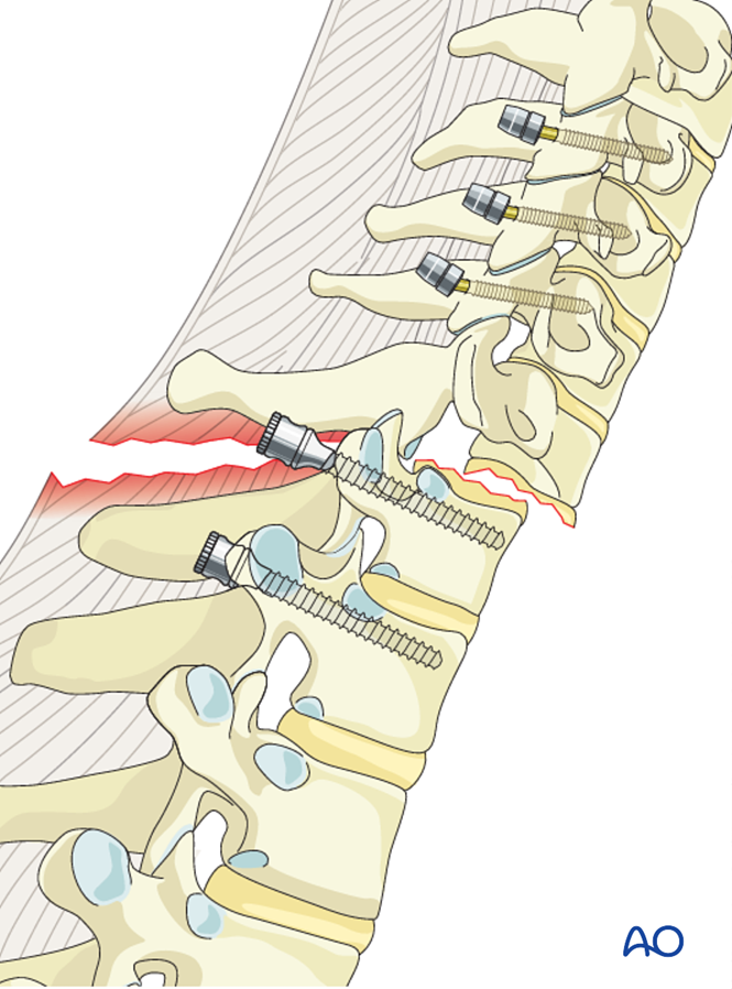 Cervicothoracic junction - posterior fixation for C Translational injury