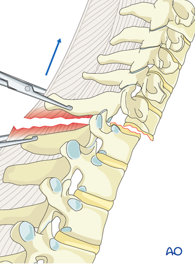 Cervicothoracic junction - posterior fixation for C Translational injury