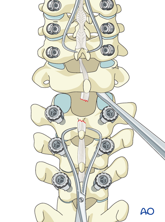 Cervicothoracic junction - posterior fixation for C Translational injury