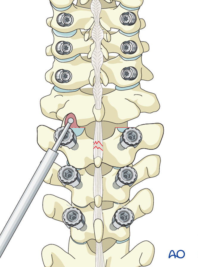 Cervicothoracic junction - posterior fixation for C Translational injury