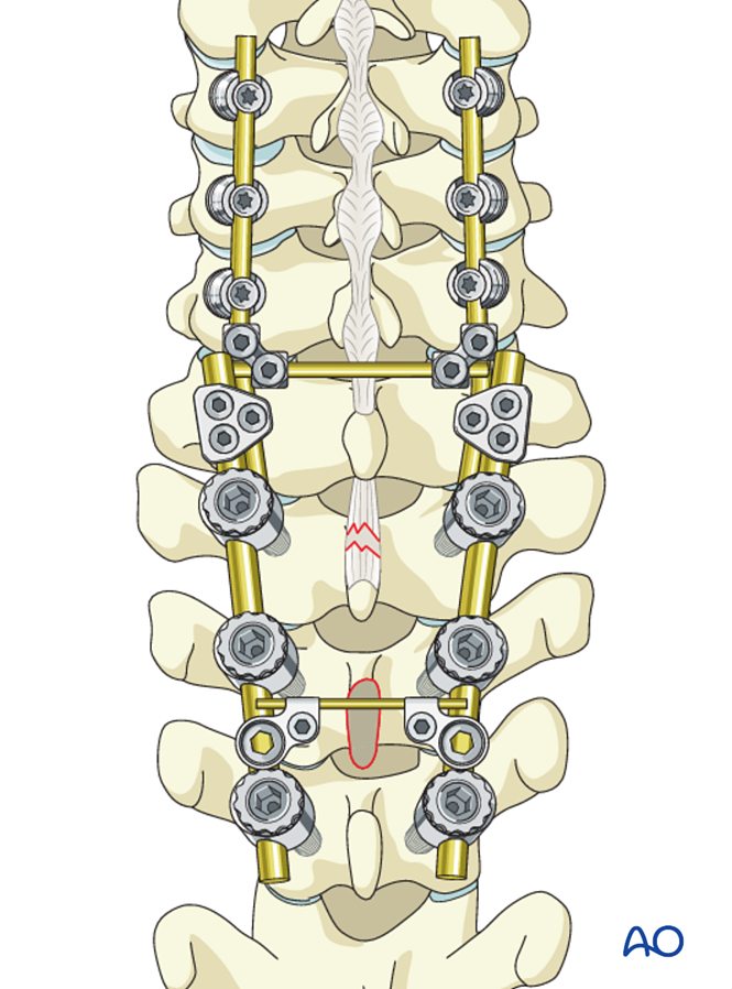 Cervicothoracic junction - posterior fixation for C Translational injury