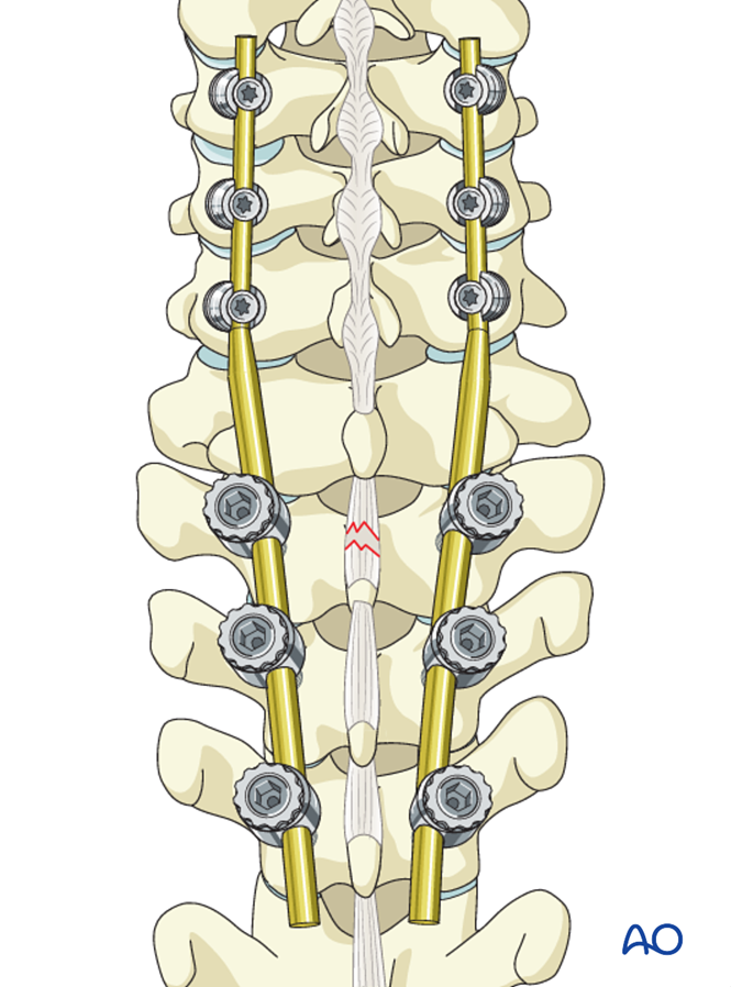 Cervicothoracic junction - posterior fixation for C Translational injury
