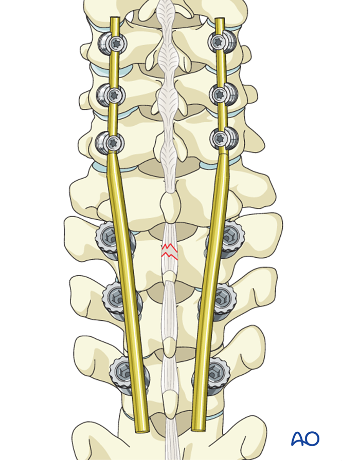 Cervicothoracic junction - posterior fixation for C Translational injury