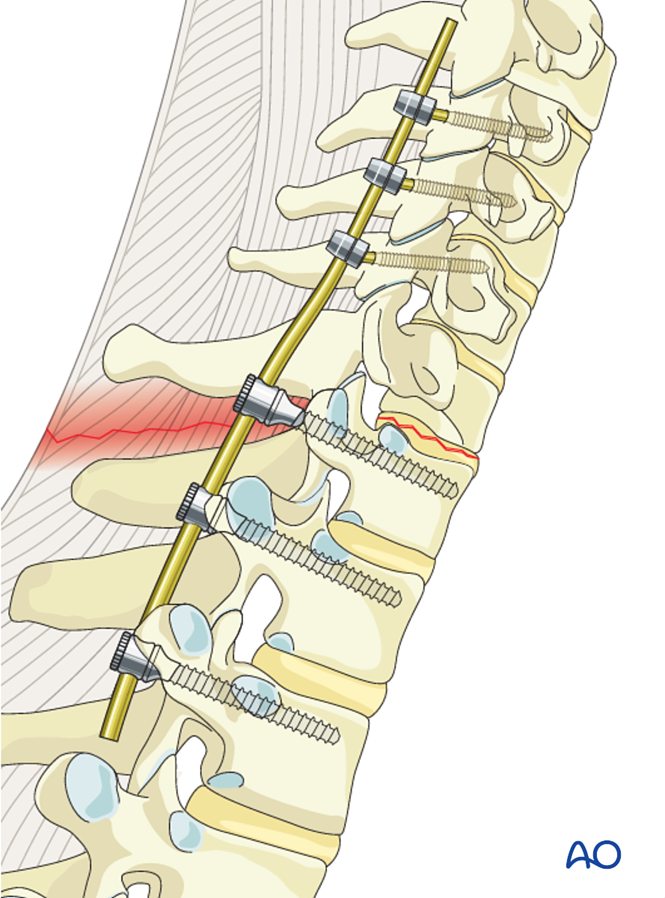 Cervicothoracic junction - posterior fixation for C Translational injury
