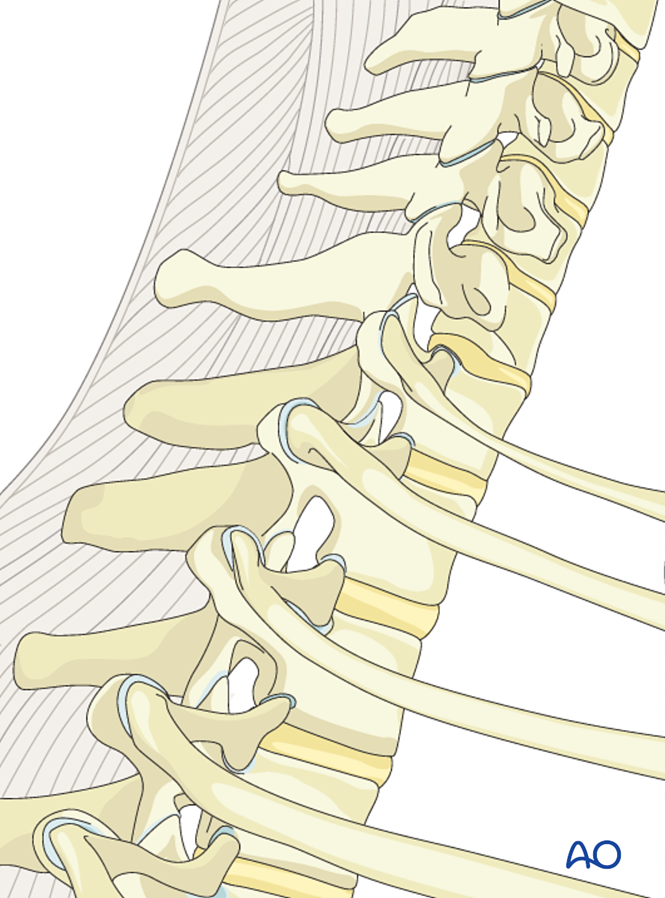 Combined anterior and posterior (360) for A2 Coronal split/pincer fracture